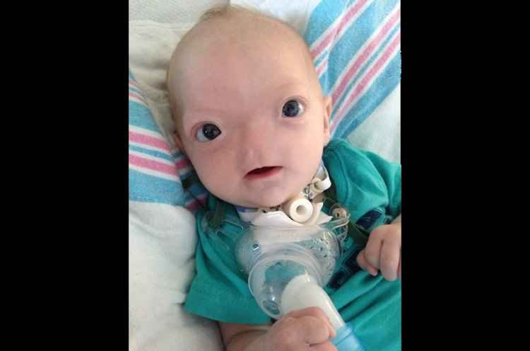 Com problema raro, bebê nasce sem nariz nos Estados Unidos - Atualidades