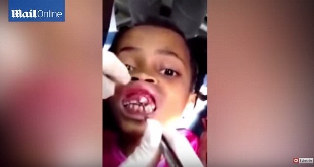 Dentista remove 15 larvas da boca de uma criança - Atualidades