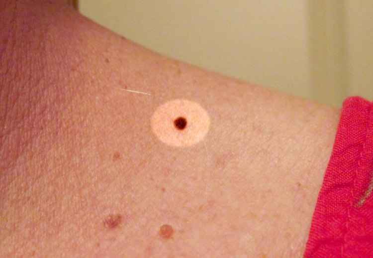 A Quantidade De Pintas No Corpo Pode Ser Sinal De Alerta Para O C ncer 