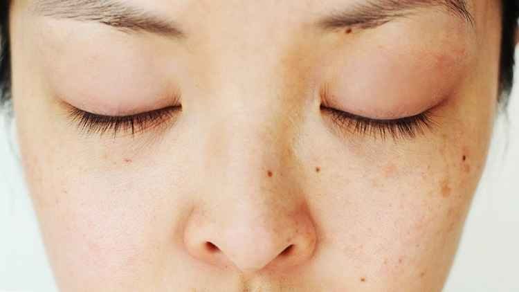 Saiba como reconhecer uma pinta cancerosa - Saúde